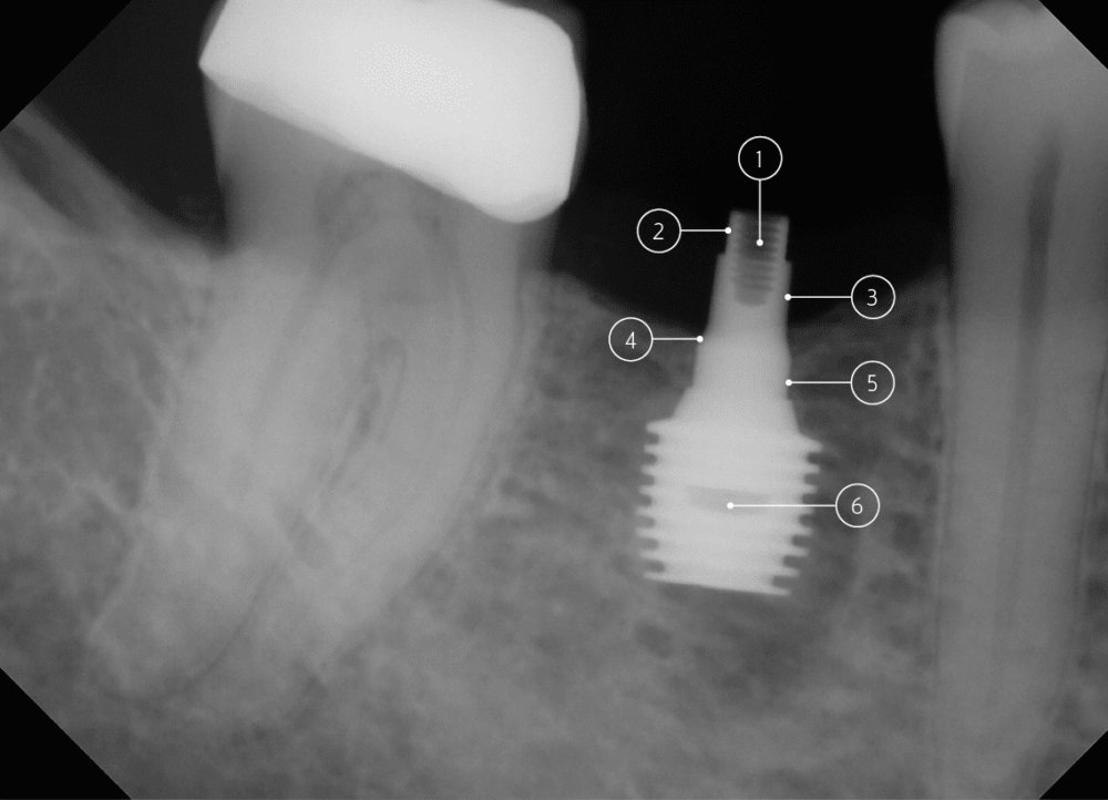 i-LiNQ® › ImplantConcept