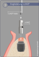 i-LiNQ® › ImplantConcept