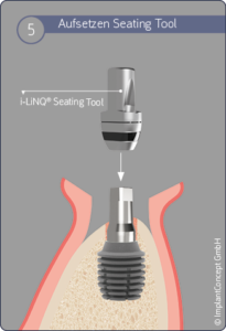 i-LiNQ® › ImplantConcept