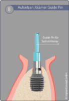 i-LiNQ® › ImplantConcept