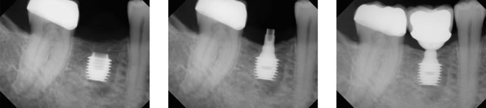 i-LiNQ® › ImplantConcept